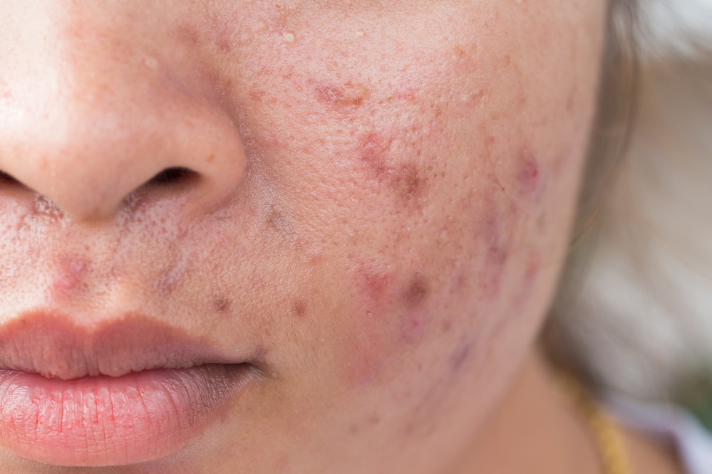 5 étapes pour se débarrasser de l'acné - DrSoleil