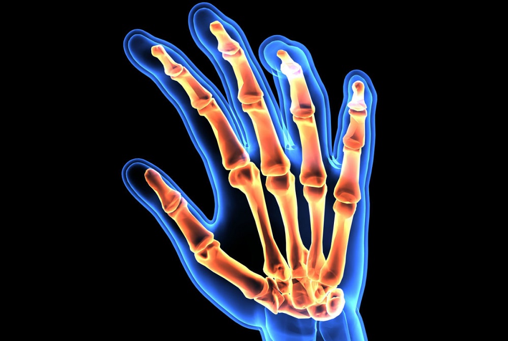 Les 5 meilleurs suppléments pour l’arthrite - DrSoleil