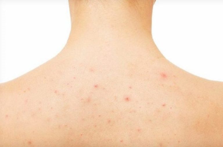 Acné du dos : 5 causes possibles - DrSoleil