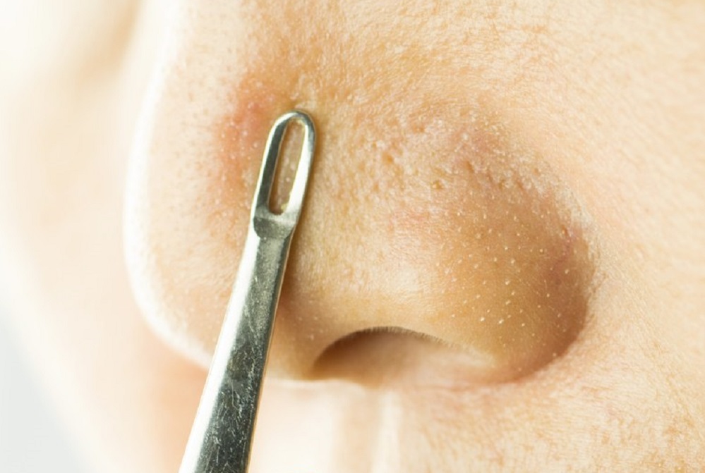 Comment extraire un bouton en 8 étapes très simples - DrSoleil