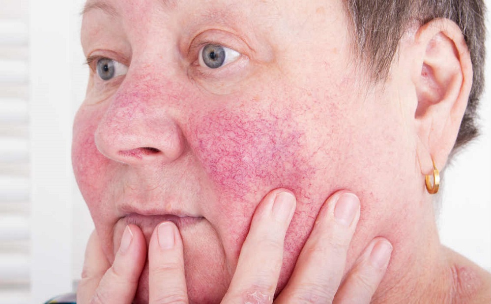 Comment se débarrasser des rougeurs sur le visage ? - DrSoleil