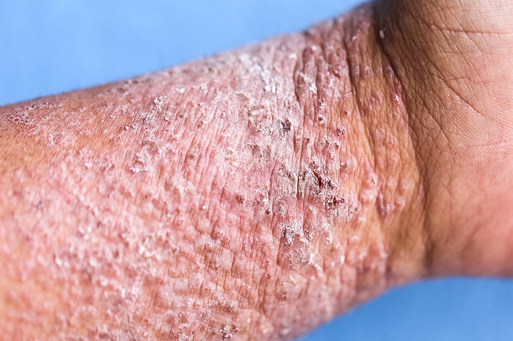 La vitamine D réduit-elle la sévérité de la dermatite atopique ? - DrSoleil