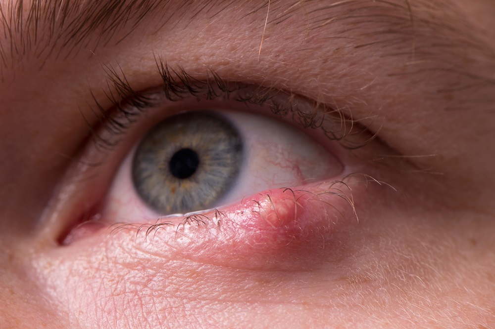 Les 8 meilleurs remèdes pour traiter un orgelet (hordeolum) - DrSoleil