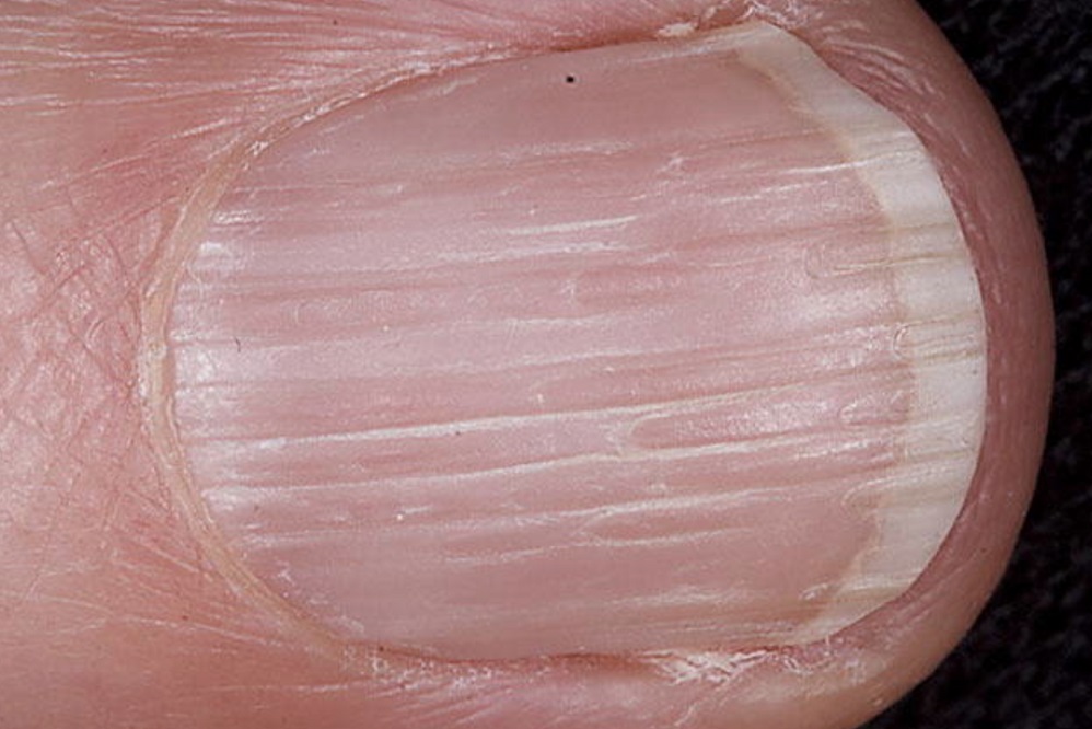 Qu'est-ce que l'onychorrhexie ? (+ remèdes) - DrSoleil