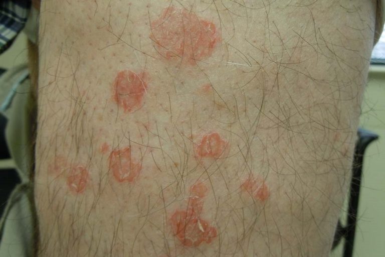 Quelle est la différence entre l'eczéma nummulaire et la teigne ...