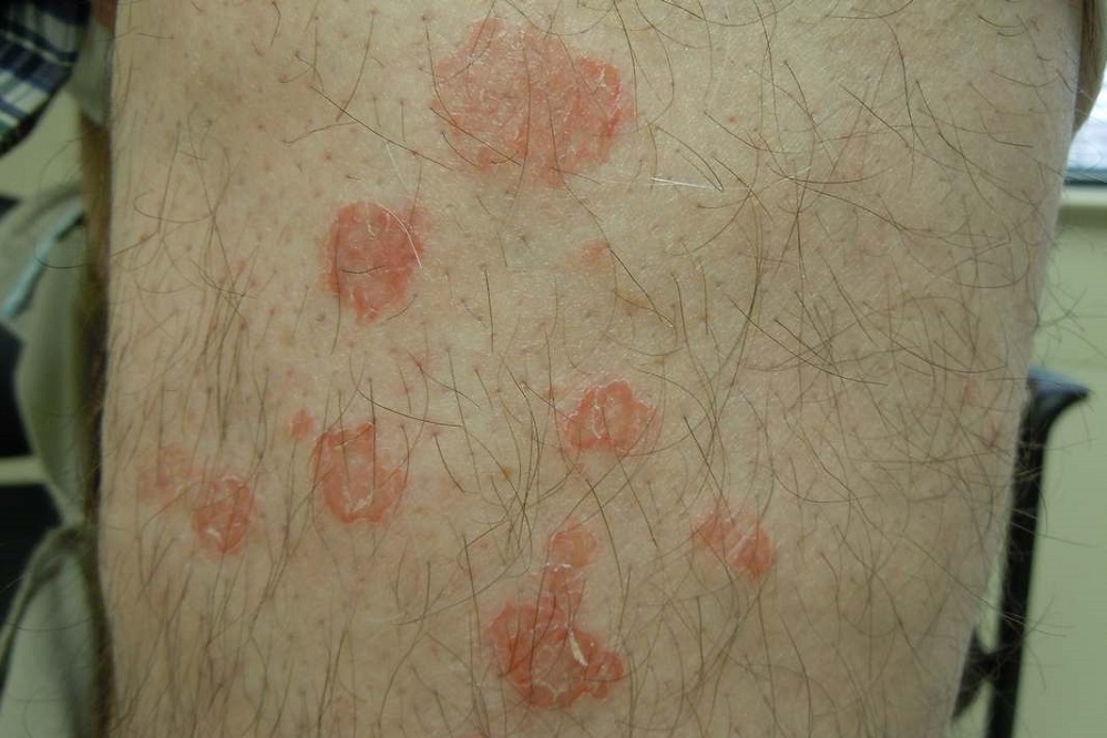 Quelle est la différence entre l'eczéma nummulaire et la teigne ...